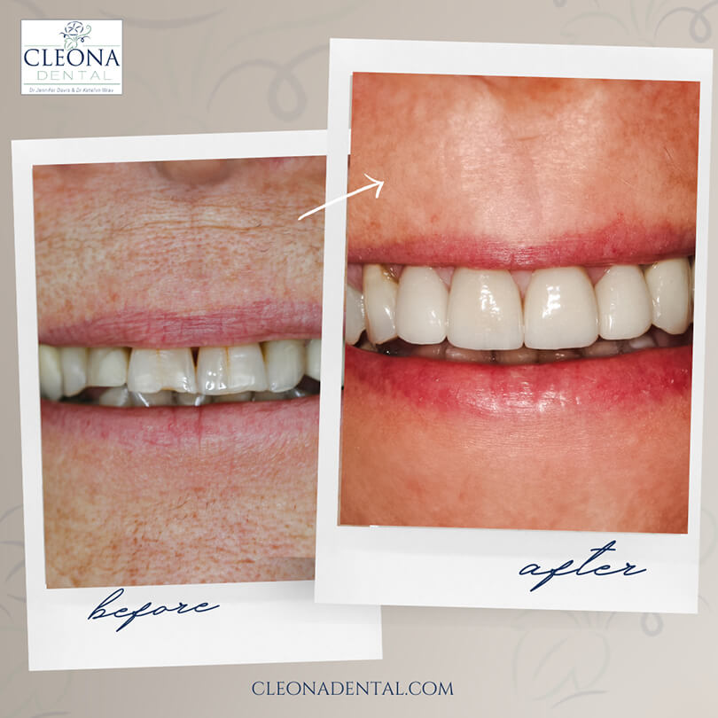 Dental Crowns in Cleona, PA | Restore & Protect Your Teeth